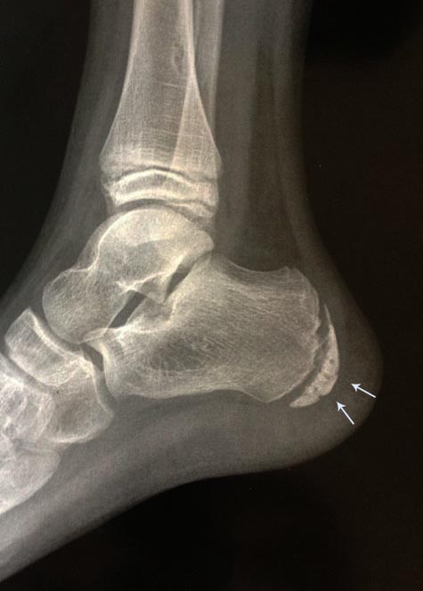 Maladie de Sever - Dr Benjamin POTENCIER